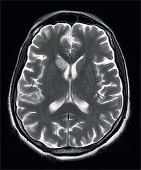 Cryptococcus Brain