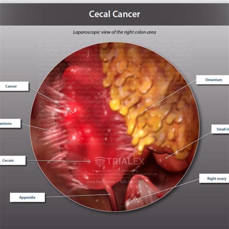 Medical Legal Exhibits Legal Animations And Trial Graphics Tria
