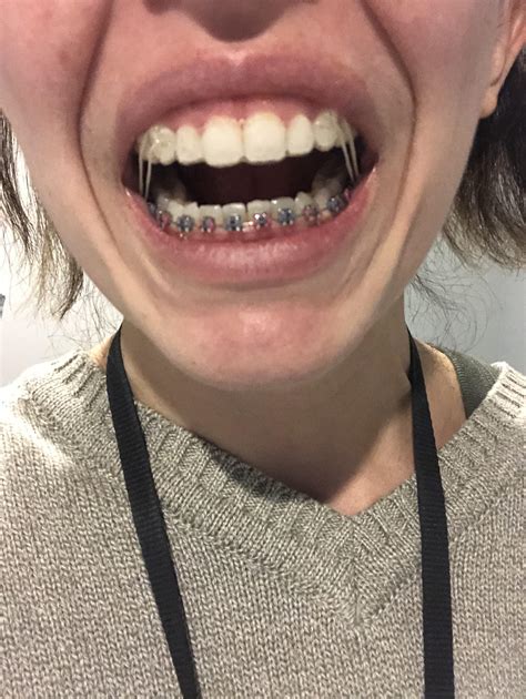 What Size Rubber Bands For Invisalign At Natasha Pruitt Blog