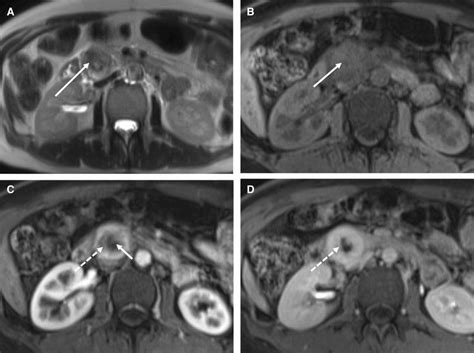 Duodenal Gist 45 Year Old Female Found To Have Mass In The Duodenum