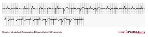 Artificial Pacemaker Wikidoc