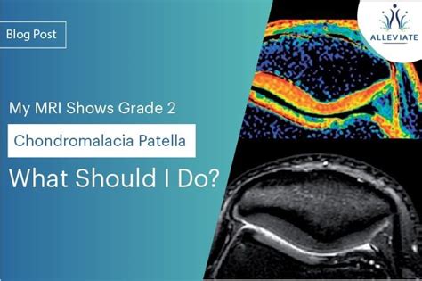 Grade 2 Chondromalacia Patella Knee Specialist Causes Treatment