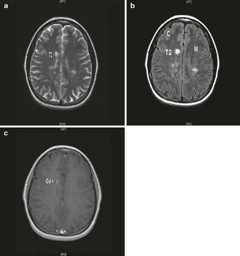 Neuroimaging In Multiple Sclerosis