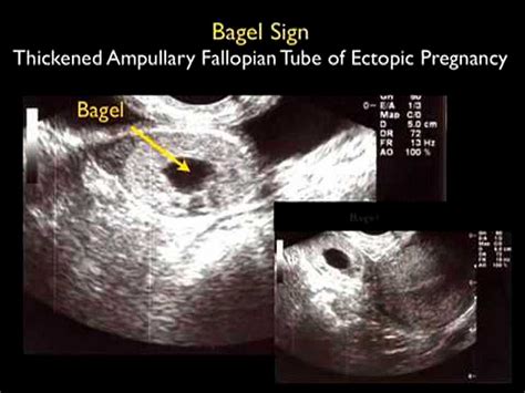 Bagel Sign Of Tubal Ectopic Pregnancy Tubal