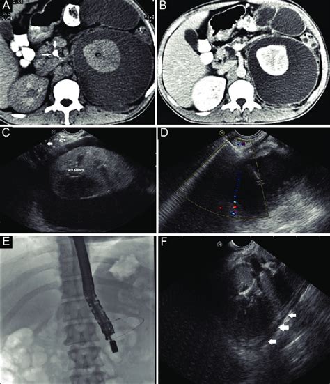 A Computed Tomography Ct Parenchymal Calcification In Head Of Download Scientific Diagram