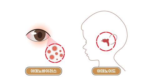 눈곱 감기 아데노바이러스 증상 및 예방법 맘가이드