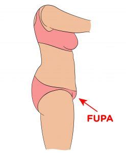 Fupa Fat Upper Pelvic Area Liposuction Phoenix Liposuction Phoenix