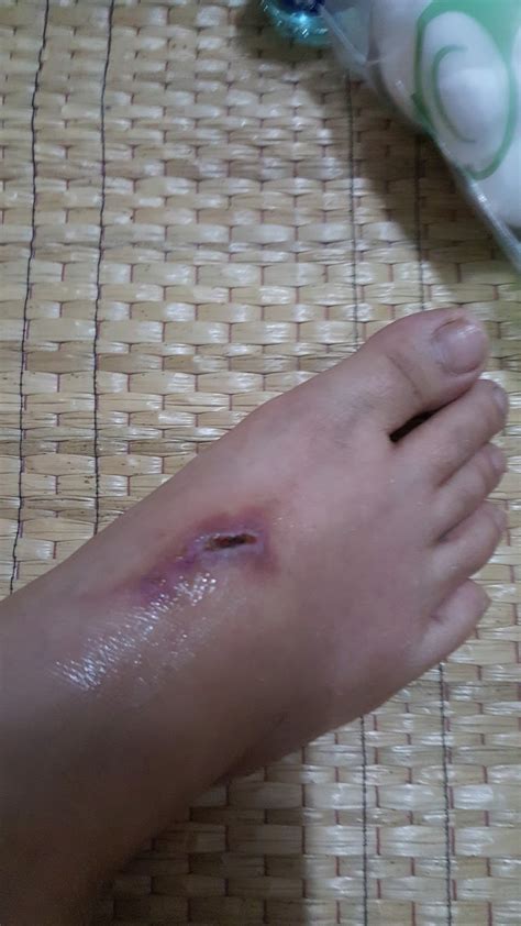 แผลเย็บ 4 เข็ม 1 เดือนผ่านไปยังไม่หาย