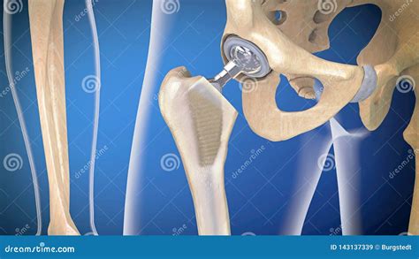 Function Of A Hip Joint Implant Or Hip Prosthesis In Frontal View Stock Illustration