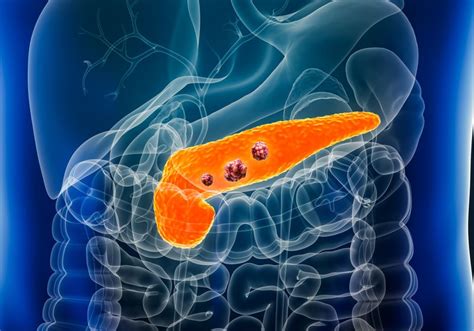 Daraxonrasib Drug Doubles Pancreatic Cancer Survival Rate In Phase 3