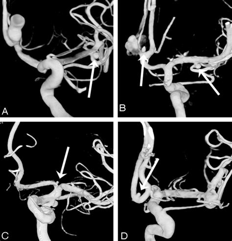 Four More Examples Of Missed Additional Aneurysms On Dsa A A Small