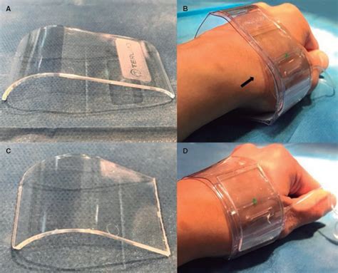 Tr Band Modification For Distal Transradial Access Hemostasis