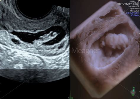 Cervical Polyp 3d Surface Render — International First Trimester