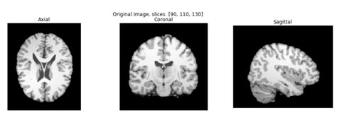 Gaussian Mixture Model For Brain Mri Segmentation