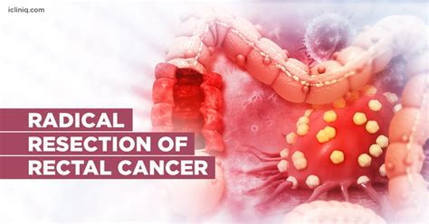 What Is Radical Resection Of Rectal Cancer