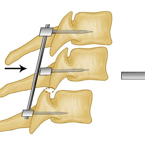 Summary Of Close Reduction Techniques For Lower Cervical Facet