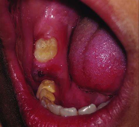 Buccal And Lingual Cortex Expansion Download Scientific Diagram