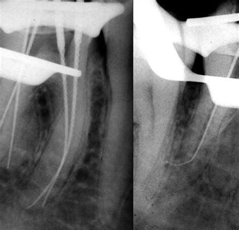 Glide Path Management Tips And Tricks Style Italiano Endodontics