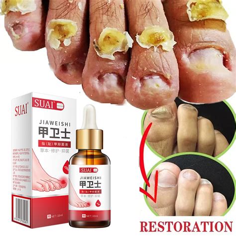 Jual 【cod】10ml Suai Ai Armor Guards Remove Ingrown Nail Essentl Oil
