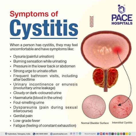 Symptoms Of Cystitis Bladder Urodynamics And Interstitial Cystitis