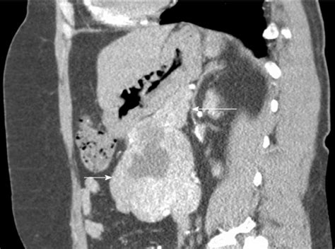 Figure 1 From Segmental Duodenectomy For Gastrointestinal Stromal Tumor