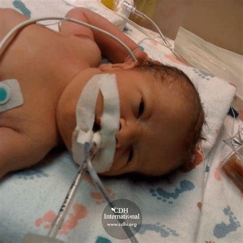 Cdh Research International Research Tpn Ascites An Uncommon Cause