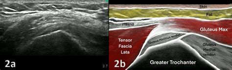 The Utilization Of Diagnostic Musculoskeletal Ultrasound In The Evaluation Of Gluteus Medius