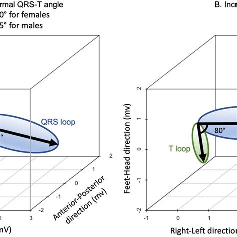 Schematic Illustration Of The Qrs T Angle A Vectorcardiographic
