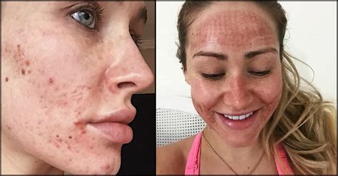 Instagram Star Says Painful Acne Treatment Was Worth It
