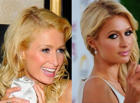 Paris Hilton Before And After Plastic Surgery Boobs Nose Eyes