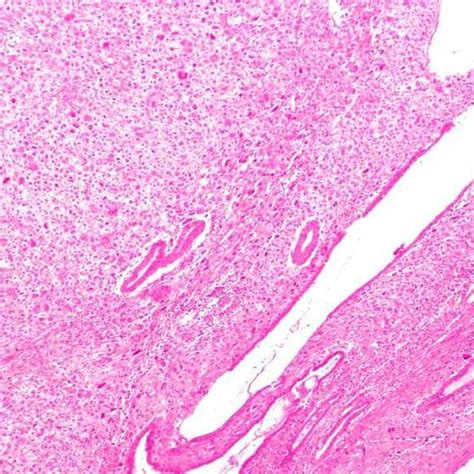 The 2009 Figo Staging System For Uterine Adenosarcoma Download Table