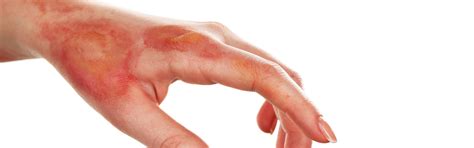 Hydrochloric Acid Burn Hand Chemical Burns Background