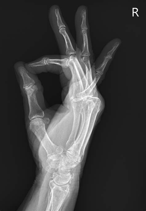 Osteoarthritis With Cppd Image