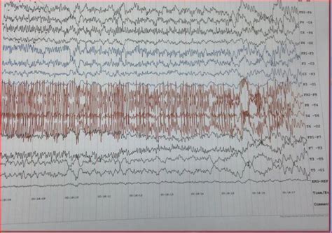 Another EEG Tracing Showing Epileptiform Discharges From Right Frontal Download Scientific