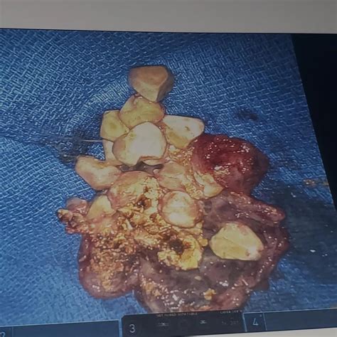19yo Male My Gallbladder Removal Was Told By My Surgeon Who Removed