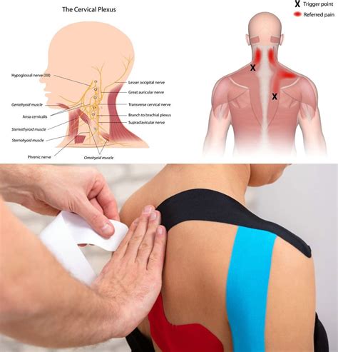 Kinesiology Tape How To Release Neck And Shoulder Trigger Points Ep