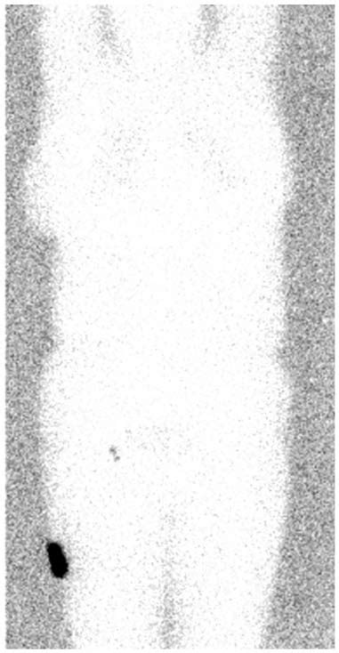 Sentinel Lymph Node Lymphoscintigraphy Which Shows 2 Inguinal Lymph