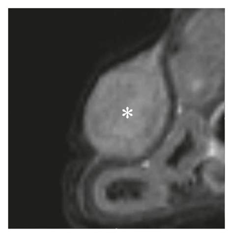 Intratumor Injection Produces Highly Inhomogeneous Distribution Of Mns