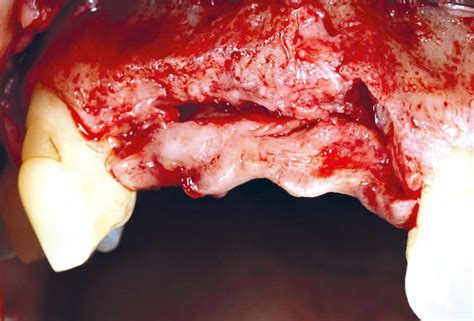 Vertical Bone Augmentation Using Tent Pole Screw Technique Prof Dr S Fickl Indication Matrix