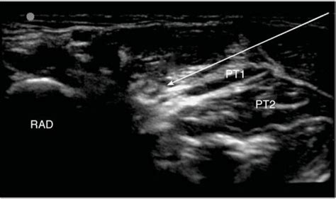 Median Nerve At The Pronator Teres Injection Wikism Sports Medicine Wiki