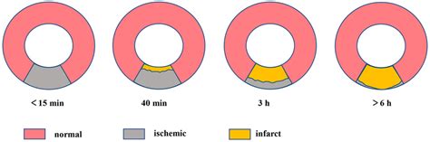 The “wavefront” Of Myocardial Ischemic Necrosis Necrosis Of