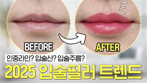 내돈내산 솔직후기 티 안 나게 어려지는 2025 입술필러 트렌드👄💉 부작용 가격 병원 고르는 꿀팁 통증 붓기 국산수입 Youtube
