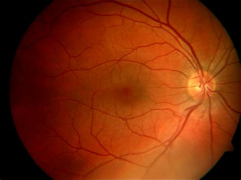 Visualization Of A Healthy Retina And An Unhealthy Retina 3 Download Scientific Diagram