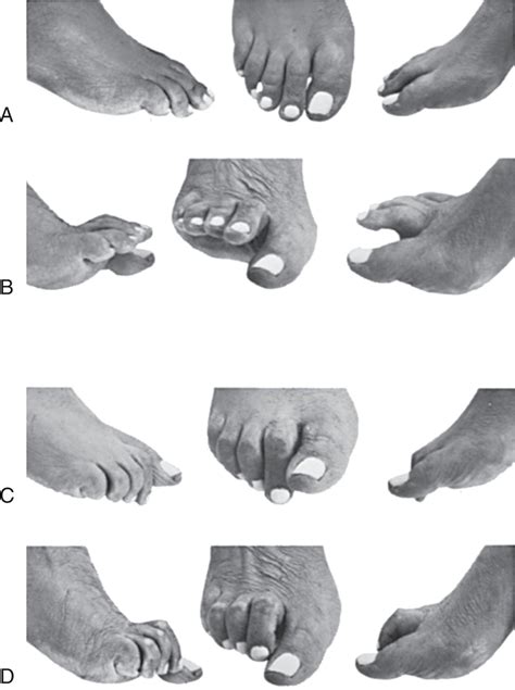 Lesser Toe Deformities Clinical Tree
