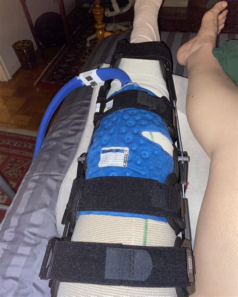 One Week Post Op For Meniscal Root Repair And I Have A Lot Of Numbness