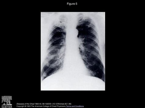 Does Chest X Ray Show Histoplasmosis At Christopher Hannan Blog