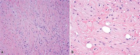 Sarcomas And Sarcomatoid Neoplasms Of The Lungs And Pleural Surfaces Clinical Tree