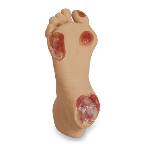 Pressure Ulcer