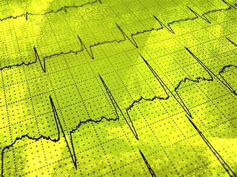 Difference Between A Flutter And Afib Missionlopers