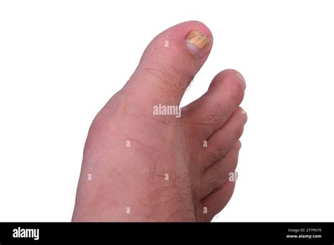 Nail Fungus Infection On Big Toe Fungal Infection On Fingernails Toe
